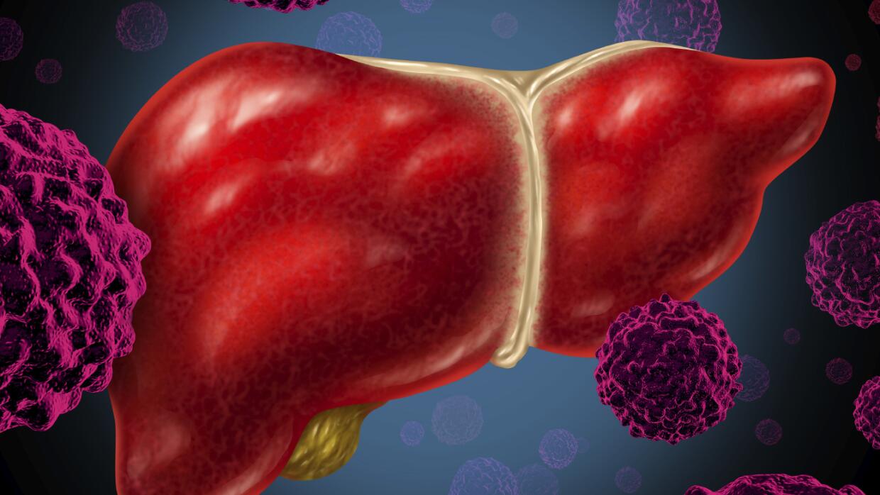 Aumenta el número de muertes por cáncer de hígado en EEUU - Univision